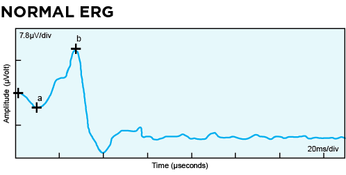 SARDS Causes and Treatment | AVCVA Virtual Library