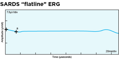 SARDS Causes and Treatment | AVCVA Virtual Library
